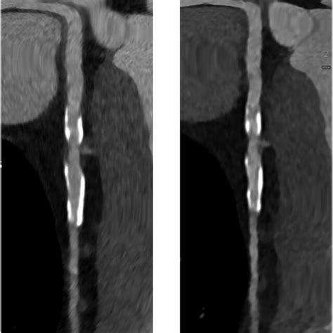 Representative Image In A Patient Scanned With The Eid And Pcd Ct