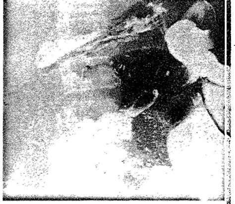 Figure 3 From Intussusception Of The Appendiceal Stump Semantic Scholar