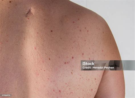 한 남자가 위생 상태가 좋지 않아 피부에 흉터와 붉은 여드름이 있습니다 피지선의 염증 클로즈업 30 34세에 대한 스톡 사진 및 기타 이미지 Istock