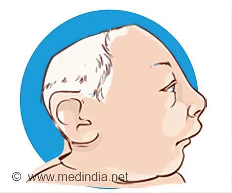 Anencephaly