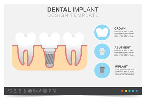 의학 치아 마케트 치과 임플란트의 구조적 요소에 대한 인포그래픽 이빨에 대한 스톡 벡터 아트 및 기타 이미지 이빨 인포
