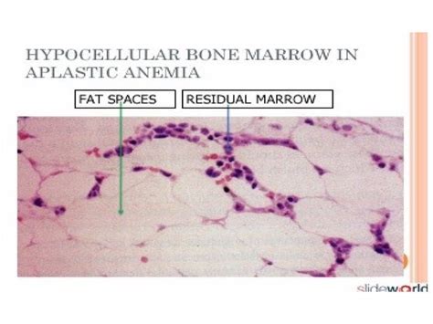 Aplastic Anemia Lecture Slides In Hematology Ppt