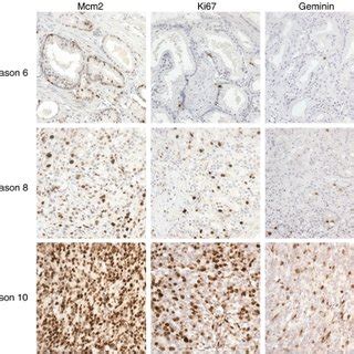 Photomicrographs Of Paraffin Embedded Tissue Sections Of Different PCa