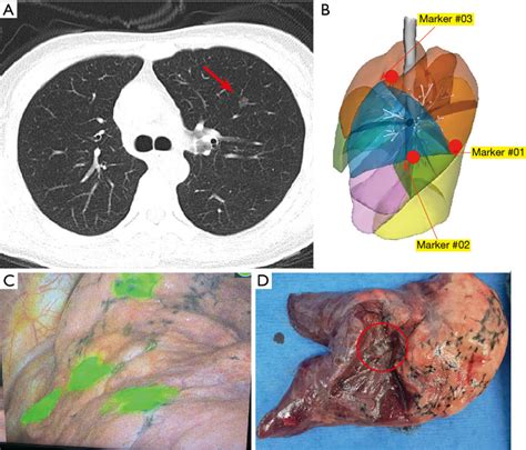 Localization Strategies For Deep Lung Nodule Using Electromagnetic Navigation Bronchoscopy And