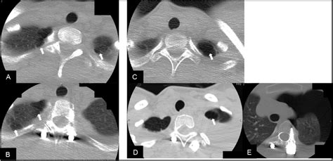 Computed Tomography Images Revealed Small Bullaeblebs Before A C