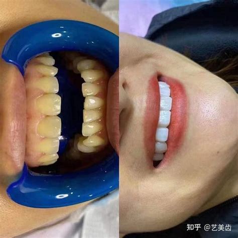 艺美齿美牙培训 我们的牙齿为什么会变黄呢 知乎