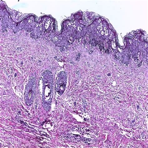 Pyoderma Gangrenosum Large Purulent Ulcer With Violaceous Undermined