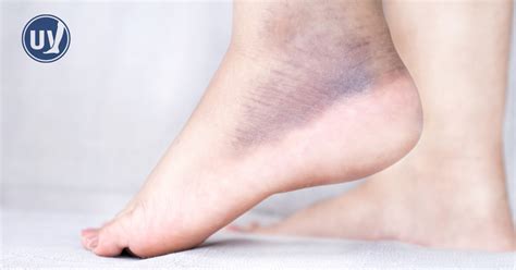 Warning Signs Of Blood Clots In The Ankle United Vein And Vascular Centers®