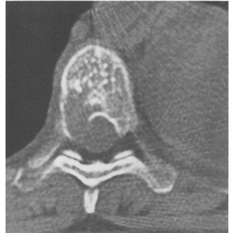 Fig Lc Ct Scan Showing An Osteolytic Metastasis Involving The 8th Download Scientific Diagram