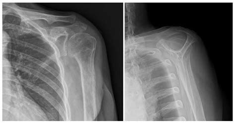 Left Shoulder X Ray Showed Diffuse Osteopenia Osteophyte At Humeral