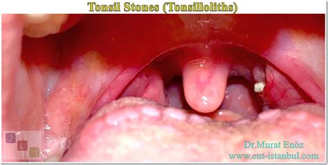Tonsil Stone Definition Symptoms And Treatment