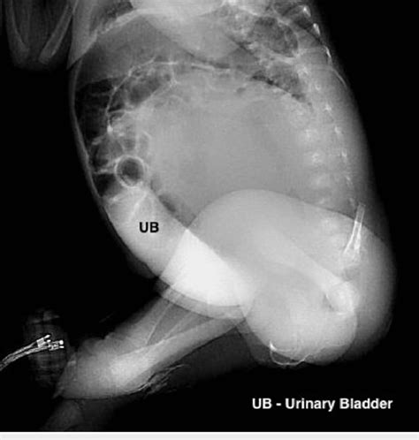 Cystourethrogram Showing Smooth Filling Of The Urinary Bladder
