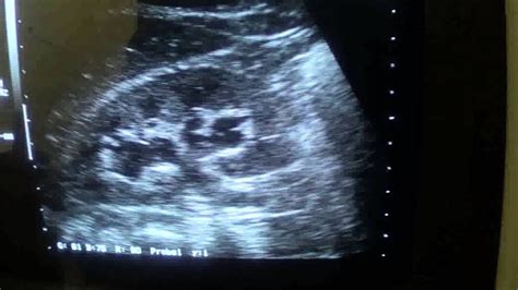 Acute Pyelonephritis Youtube