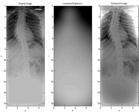 Computer Assisted Cobb Angle Measurements A Novel Algorithm