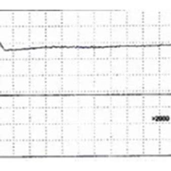Electrocardiogram ECG Tracing From The Loop Recorder Showing Sinus Download Scientific