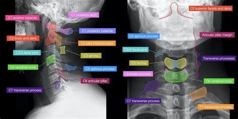 Labelled Ap And Lateral C Spine Diagram Quizlet