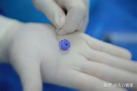 应用于先心病治疗！新型“可降解封堵器”助力探索治疗新路 知乎