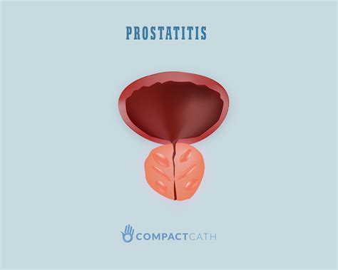 Prostatitis Archives Compactcath