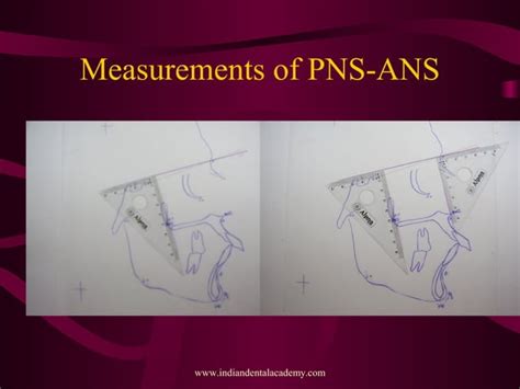 COGS Analysis Cephelometrics For Orthognathic Surgery Fixed Orthodontics Courses India PPT