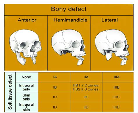 Mandibulectomy Defect Classification System Download Scientific Diagram