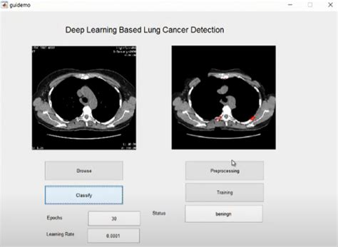 3 D Lung Tumor Segmentation Using Deep Learning Matlab Deep Learning