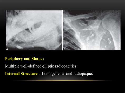 Soft Tissue Calcifications Of The Oral Cavity Pptx