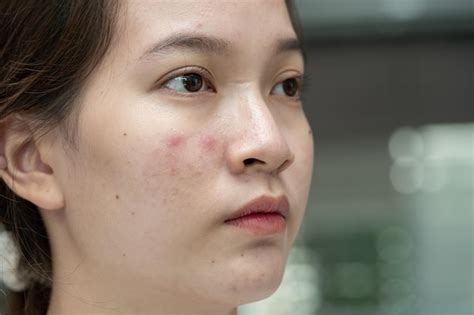 Premium Photo Asian Young With Pimple Acne Scar On Skin Facial Problem