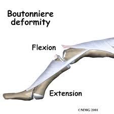 Boutonnière Deformity Hand And Elbow Conditions