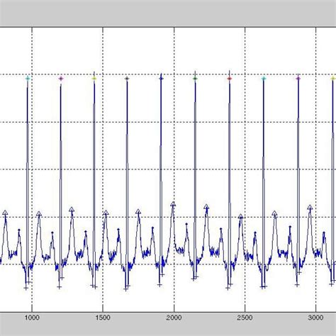 Detected R Peaks In Sample Ecg Signal Download Scientific Diagram
