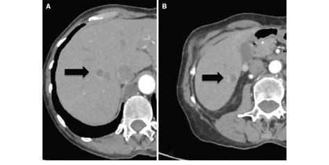 Ct Scan In Arterial Phase At 3 Weeks Post Embolization Confirmed Lack Download Scientific