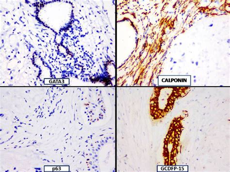 Immunohistochemical Characteristics Of Primary Extraskeletal Myxoid Download Scientific Diagram