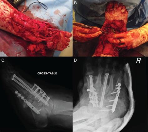 Limb Salvage Talectomy For 3c Gustilo Anderson Fracture Pmc