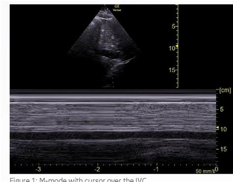 Figure 1 From Venue Family Auto Tool For Measuring IVC Collapsibility Index A Semantic Scholar