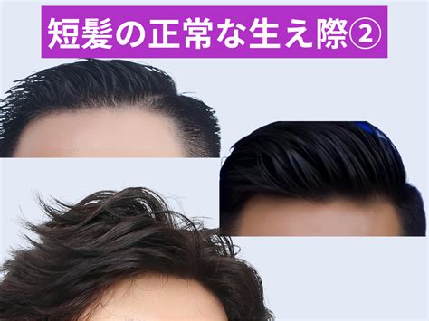 正常な生え際事例14選!【画像付き】 Agaメディア 正常な生え際事例14選!【画像付き】 Agaメディア