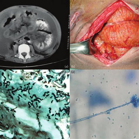 A Abdomen Ct Scan Showing Severe Intestinal Ileus With Massive Turbid