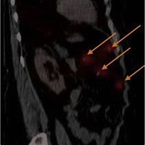 Abdominal Ct Scan Of A Splenic Nodule Before And After Contrast Medium