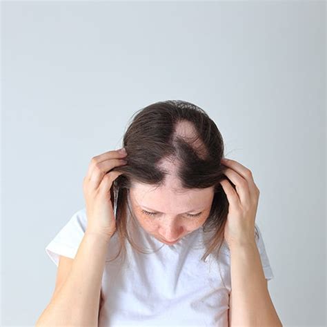 Алопеция ареата Лечение Дерматолог в гр София