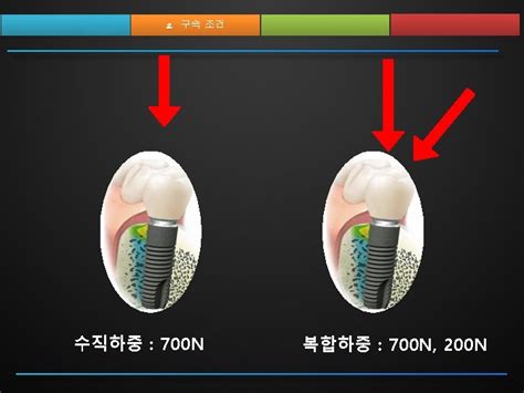 1 Branemark Implant 3 I Implant Imz Implant