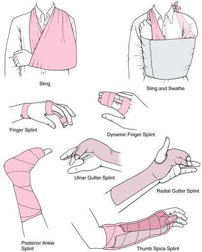 Various Splints For Broken Bones Do You Know What Is A SAM Splint It Is A First Aid Item That