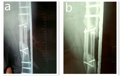 A Radiograph 6 Months After The Graft B Radiograph 12 Months After Download Scientific