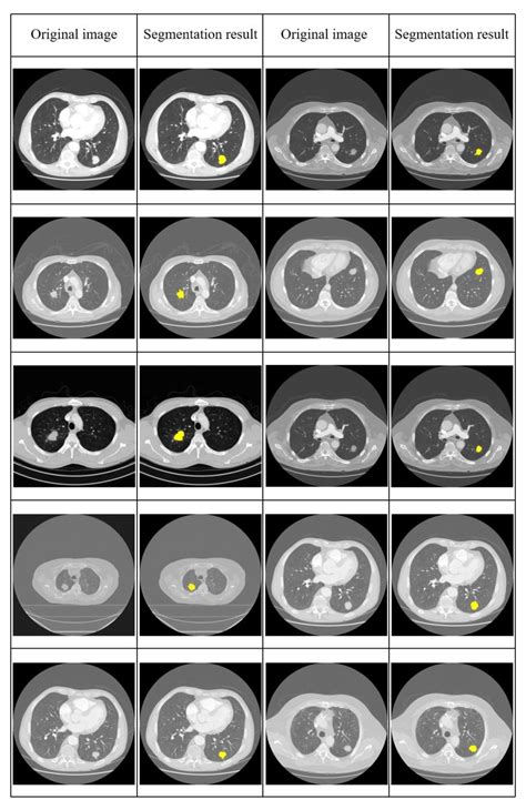 An Automatic Segmentation Method For Lung Tumor Based On Improved