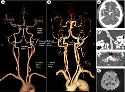 Absence Of Bilateral Internal Carotid Arteries With Multiple Download Scientific Diagram
