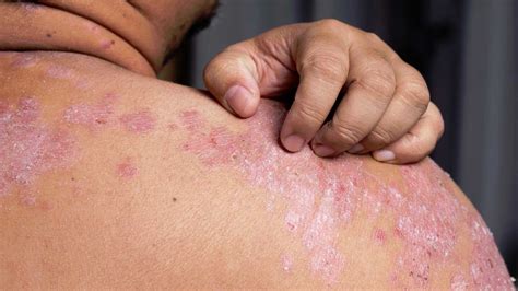 ¿qué Es La Psoriasis Prensa Antártica