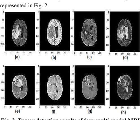 Table From An Efficient Cascaded CNN Architecture For Brain Tumor Detection In MRI Images