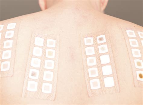 Patch Test Tudo O Que Você Precisa Saber