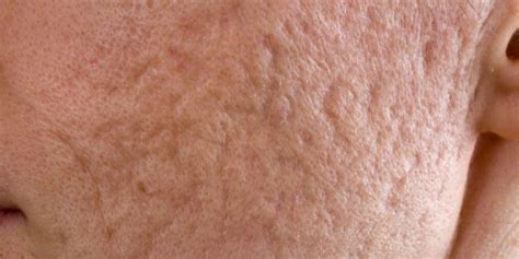 Pockmarks On Face Meaning Causes And Best Treatments