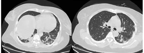 Thoracic Ct Scan Showed Lesions Compatible With A Sars Cov 2 Infection Download Scientific