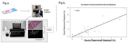 Development Of A Portable Device To Quantify Hepatic Steatosis In