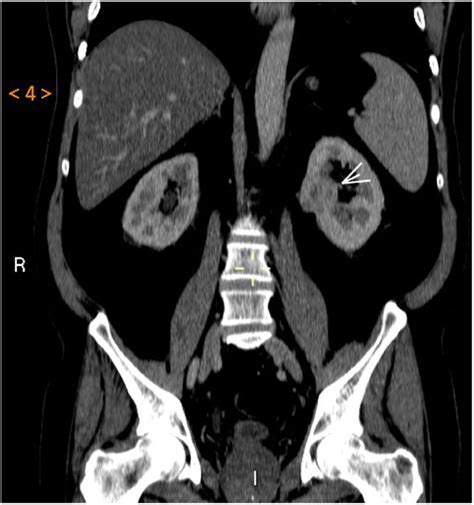 Spiny Keratoderma As A Paraneoplastic Condition In Clear Cell Renal Cell Carcinoma Actas Dermo