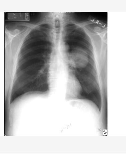 Respiratory Lecture Thoracic Surgery Flashcards Quizlet
